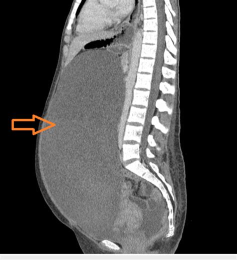 Pelvic Ct Scan