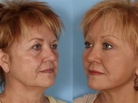 antes y despues lifting facial blefaroplastia y dermoabrasión Dr