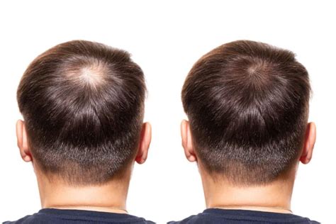 Perte De Cheveux Homme Mieux La Comprendre Men S Shampoo