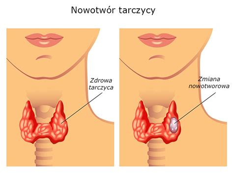 Objawy Nowotwor W Tarczycy Alfa Lek