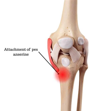 Pes Anserine Bursitis Causes Symptoms Treatment Guide Off