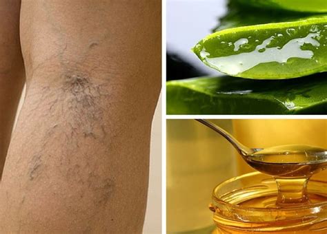 Remedios Caseros Para Las Varices ViviendoSanos