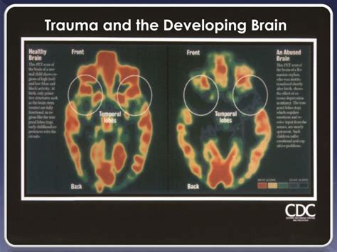 Ppt The Neuro Biological Impact Of Trauma On The Brain Powerpoint