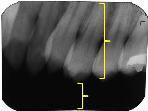 Errores En La Toma De Radiografias Intraorales Ppt