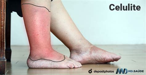 Celulite Infecciosa O Que Sintomas E Tratamento