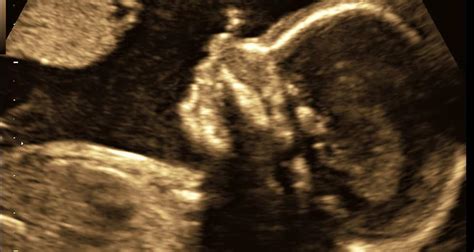 Morfol Gica Fetalmed Medicina Fetal Em Curitiba