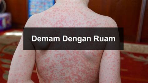 Demam Ruam Punca Simptom Dan Rawatan The Diagnosa