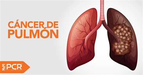 Cáncer de Pulmón PCR