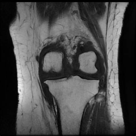 Pes Anserine Bursitis Image Radiopaedia Org