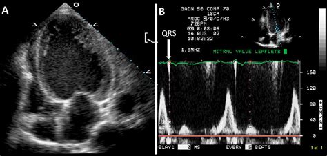 Echocardiography Findings In Common Primary And Secondary
