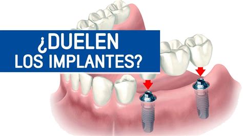 Qué tan dolorosos son los implantes dentales Parte 1 Cubdens Dental