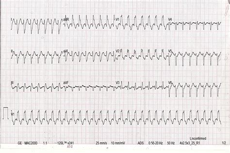 A Case Report Of Fascicular Ventricular Tachycardia In A COVID 19