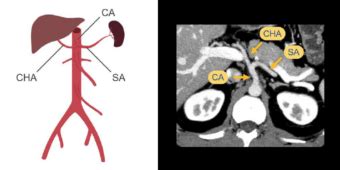Abdominal CT Abdominal Arteries LITFL Radiology Library