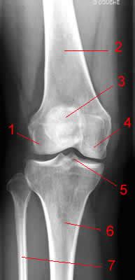 Radiographie Du Genou Anatomie D Taill E
