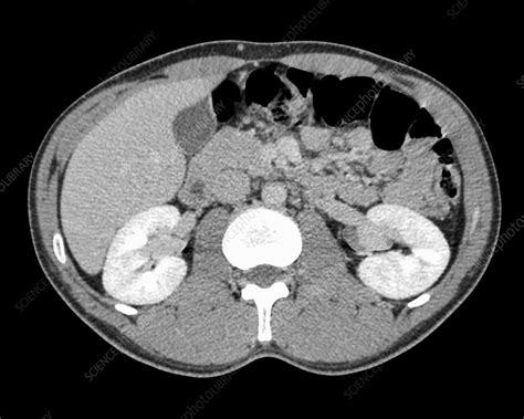 Normal Abdominal Organs CT Scan Stock Image C016 6686 Science
