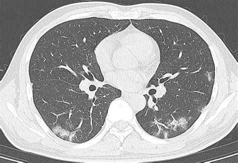 Sensitivity Of Chest CT For COVID 19 Comparison To RT PCR Radiology