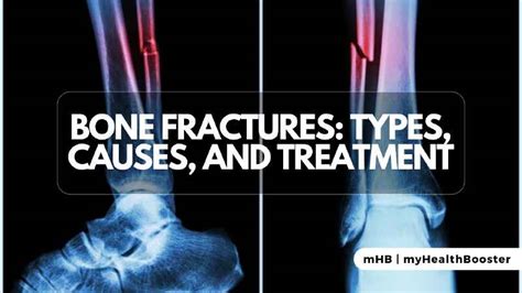 Bone Fractures Types Causes And Treatment MyHealthBooster