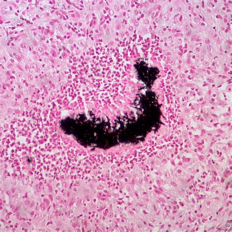 Eumycotic Mycetoma GMS Over H E Ed Uthman Flickr