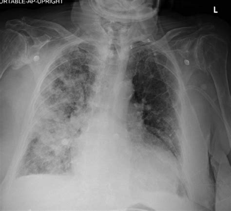 Cureus Unilateral Diffuse Alveolar Hemorrhage Due To Selective