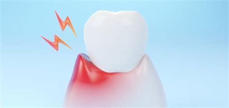 La récession gingivale Centre Dentaire RDP