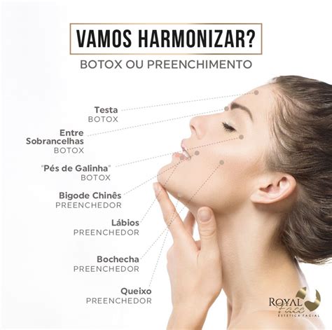 A Combina O Destes Dois Procedimentos Botox Toxina Botul Nica E