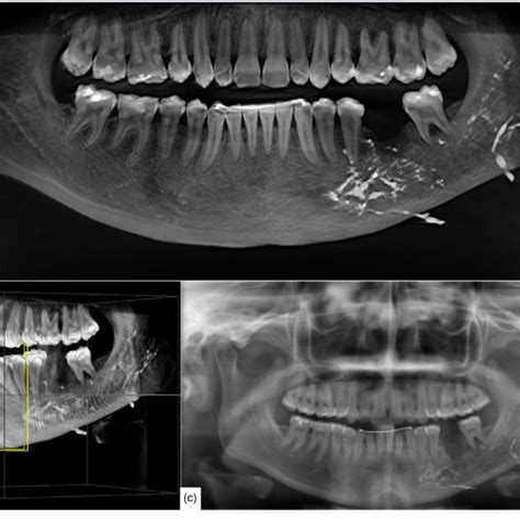 a panoramic reconstruction of cone beam computed tomography showing download scientific