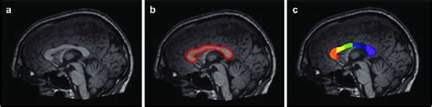 an example of corpus callosum area segmentation the figure shows download scientific diagram