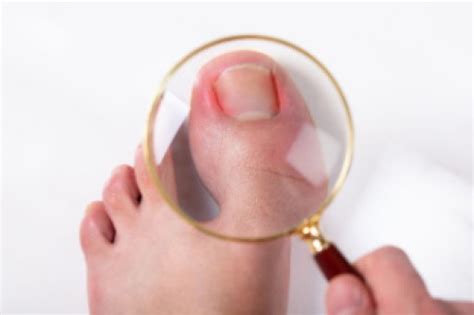 Stages And Symptoms Of An Ingrown Toenail Blog