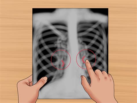 How To Read A Chest X Ray Wiki Radiological Health English