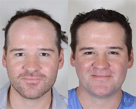 Neograft Before After Town Country Plastic Surgeons And Medspa