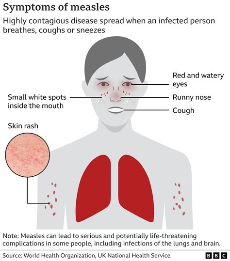 Measles MMR Vaccine Campaign Launched In Northern Ireland