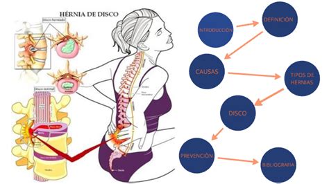 Hernia Discal By Karolina Gomez On Prezi