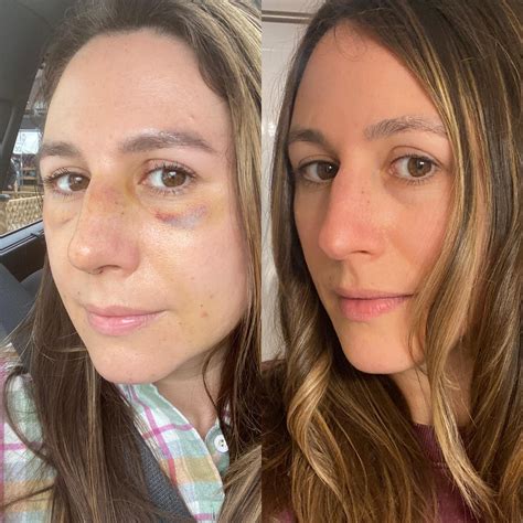 Rhinoplasty Cast Removal Day Rplasticsurgery
