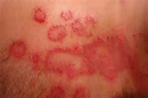 Fungal Skin Infections Rash At Dawn Moore Blog