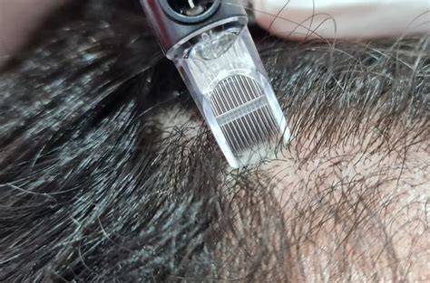 MMP Capilar Microinfusión de medicamentos en la piel Dr Pelo Injerto
