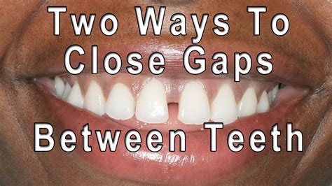 How To Reduce Gap In Teeth At Roy Silver Blog