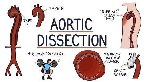 Understanding Aortic Dissection YouTube