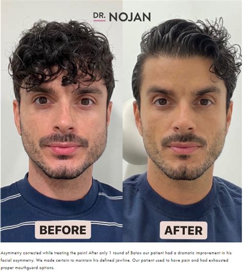 Albums 93 Images Tmj Surgery Before And After Photos Full HD 2k 4k