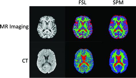 A Comparison Of Global Brain Volumetrics Obtained From CT Versus MRI