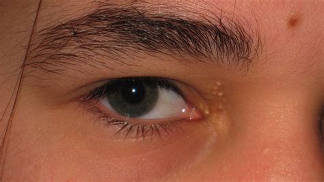 Treatment For Lump Inside Eyelid Chalazion Eyelid Cyst Mr David