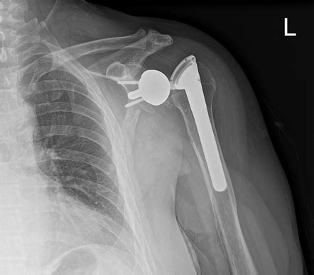Reverse Total Shoulder Arthroplasty With Polyethylene Liner