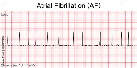 Electrocardiogram Show Atrial Fibrillation Af Pattern Cardiac