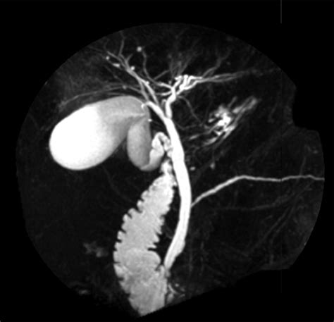 ERCP MRCP Mike Thomson Paediatric Gastroenterologist