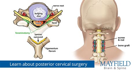 Posterior Cervical Surgery Mayfield Brain Spine Cincinnati Ohio