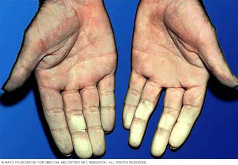 Enfermedad de Raynaud Síntomas y causas Mayo Clinic