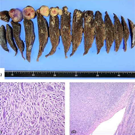 Macroscopic And Pathological Findings Of The Resected Specimen A The