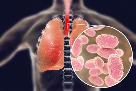 Pertussis A Tale Of Two Vaccines