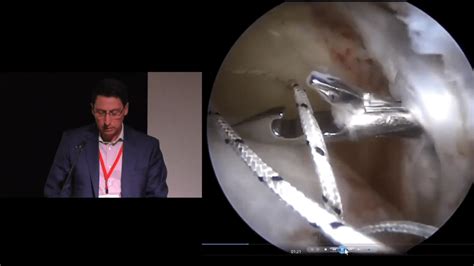 Superior Capsular Reconstruction Surgical Steps Johnson Johnson