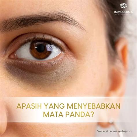 Apa Penyebab Mata Panda Immoderma Skin Clinic
