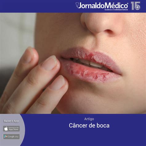 Câncer de boca Jornal do Médico